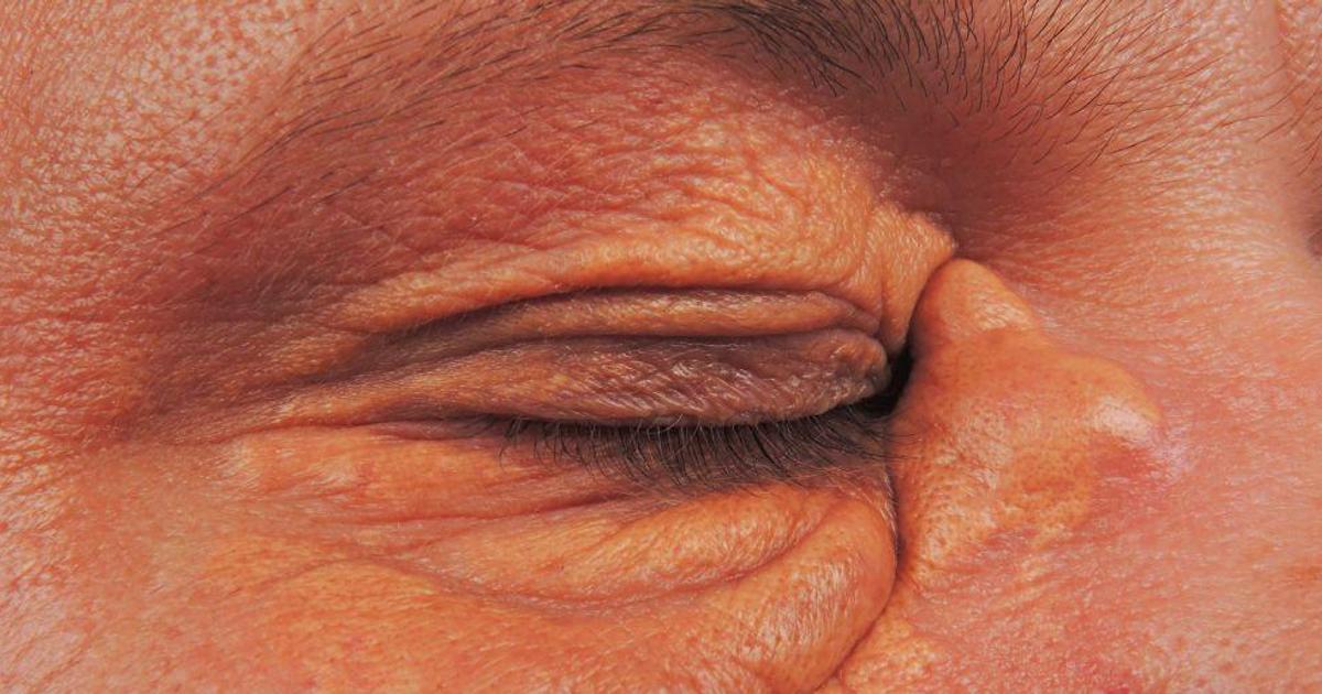 Watch Dr. Pimple Popper Remove a Skin Condition You've Never Seen ...