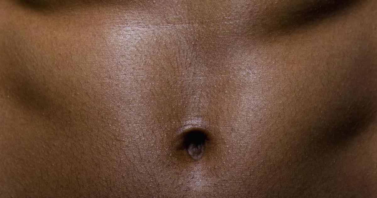Watch Dr. Pimple Popper Remove a Sticky 'Belly Button' Blackhead ...