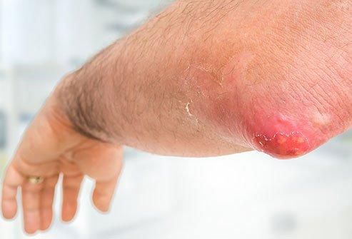 5 natural home remedies to effectively get rid of heat boils | Pulse Ghana