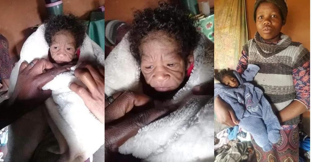 Rare medical condition makes 2-month-old baby girl look old with ...