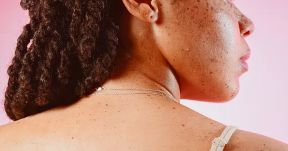 Why skin tags develop and how to remove them | Pulse Ghana