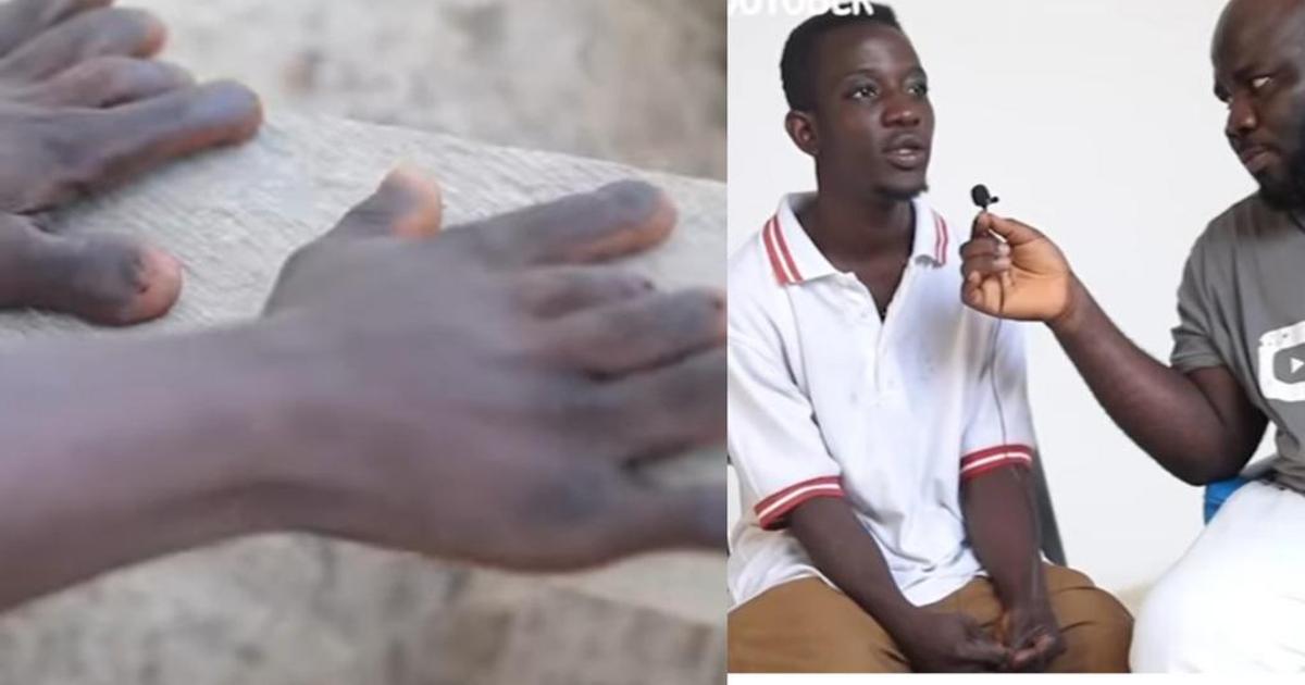 Ghanaian man who has 12 fingers, both penis and vagina begs for help ...