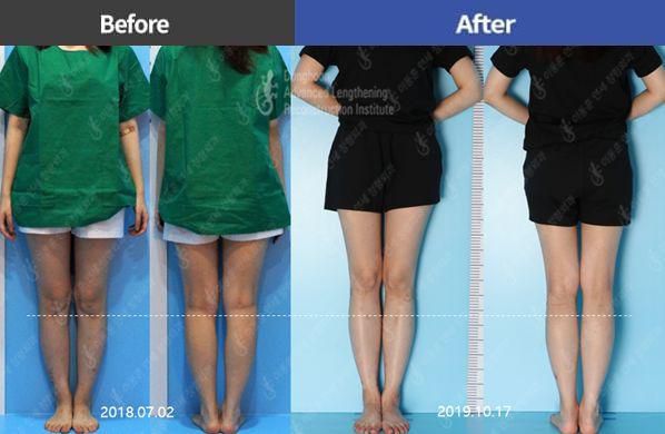 Height surgery: All you need to know about the surgery that can make ...