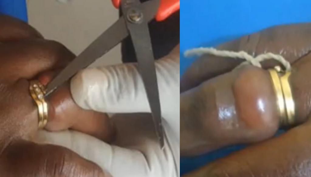 Woman almost lost finger after wearing wedding ring bought from her ...