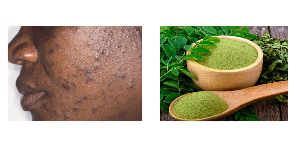 Did you know moringa leaves can clear acne and pimples? Here’s how ...