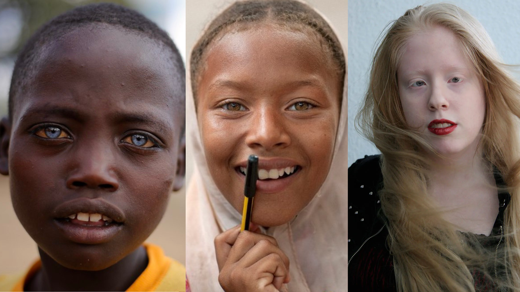 5 types of albinos and how they look | Pulse Ghana