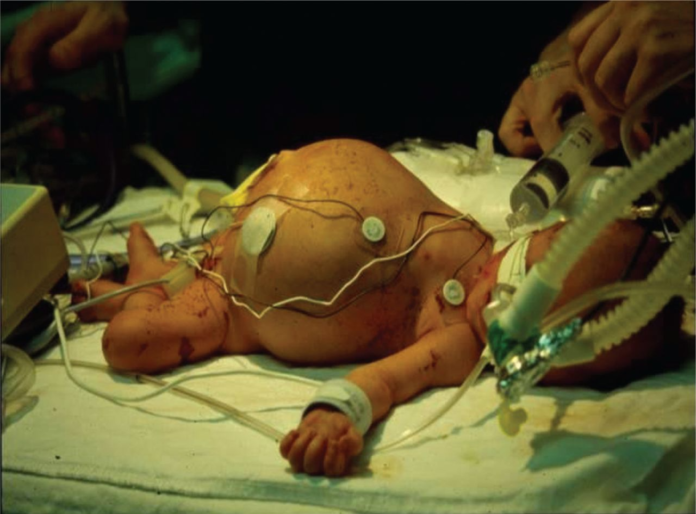 When A Baby Is Born Pregnant Understanding The Fetus In Fetu