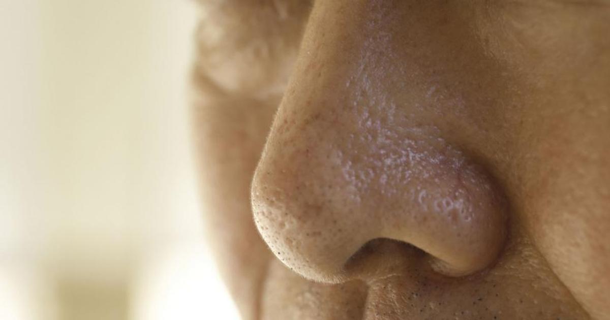 Dr. Pimple Popper Helped a Man Overcome a Skin Condition on His Nose ...