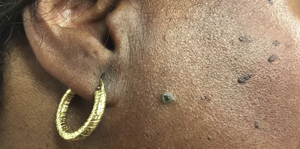 Dr. Pimple Popper Just Popped A Sticky Dilated Pore Of Winer In New ...