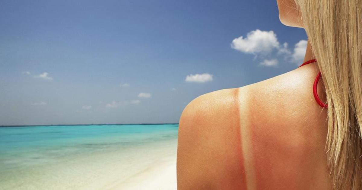 Itchy Sunburn? Here's How To Relieve Hell's Itch, According To Experts ...