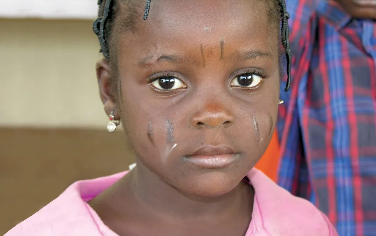 Silent but Deadly: Understanding Buruli Ulcer and Its Toll on Adamawa Residents | Pulse Nigeria