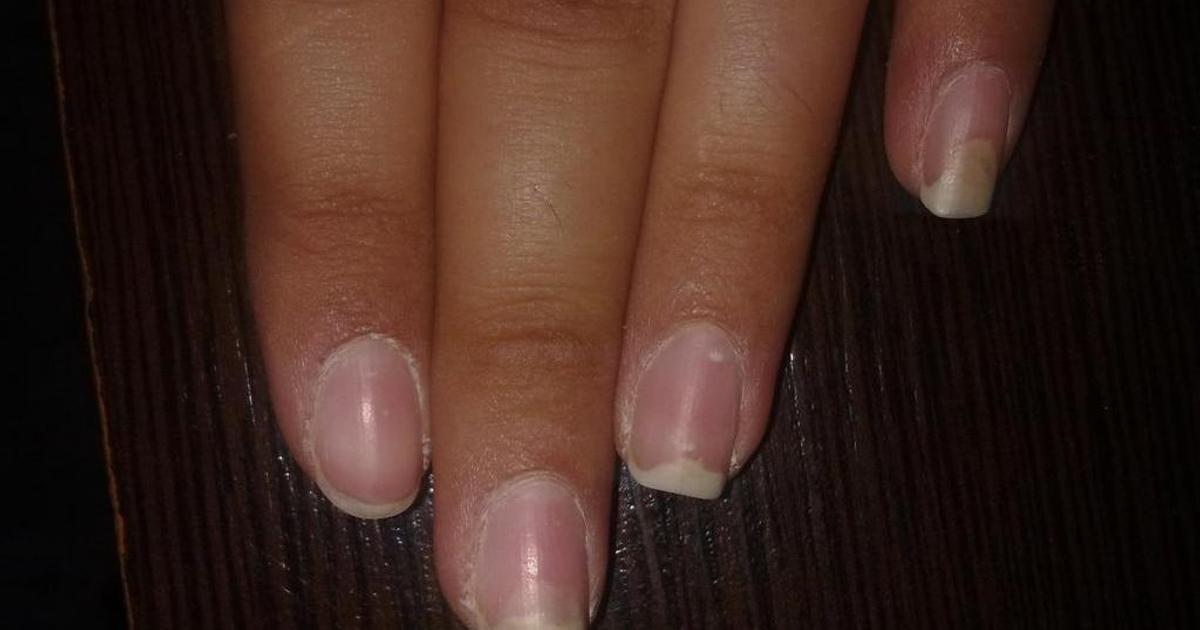 Causes and treatment of fingernails falling off | Pulse Nigeria