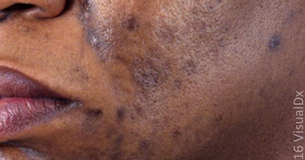 What this Chinese face mapping technique reveals about the cause of ...