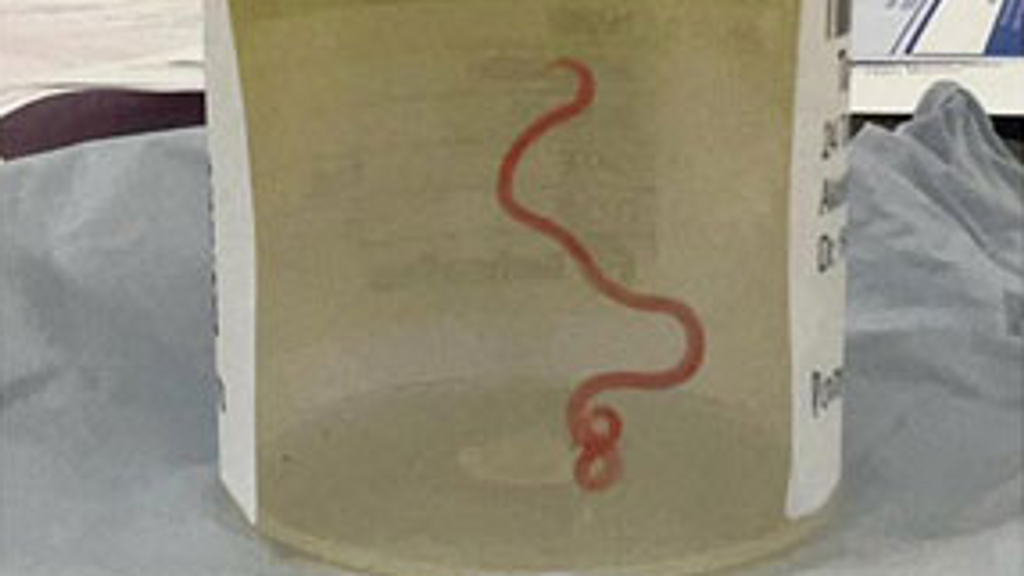 For the first time in history, a live worm was found in a woman's brain ...