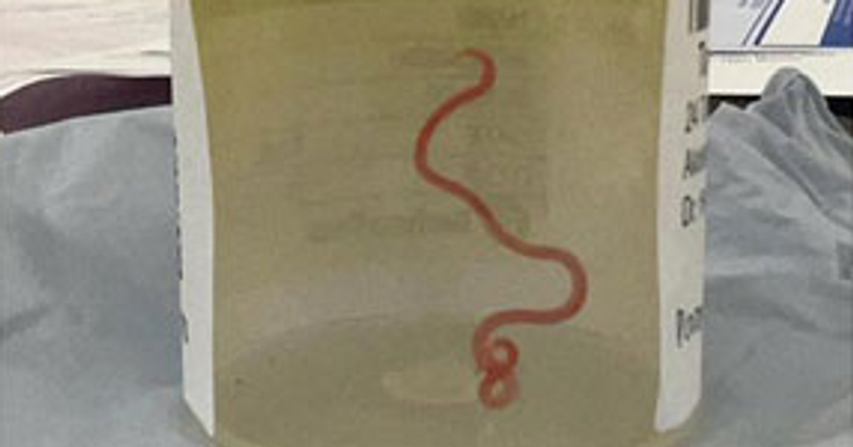 For the first time in history, a live worm was found in a woman's brain ...