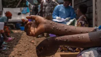 Fièvre de la Vallée du Rift : le bilan grimpe à 17 morts et 119 cas ...