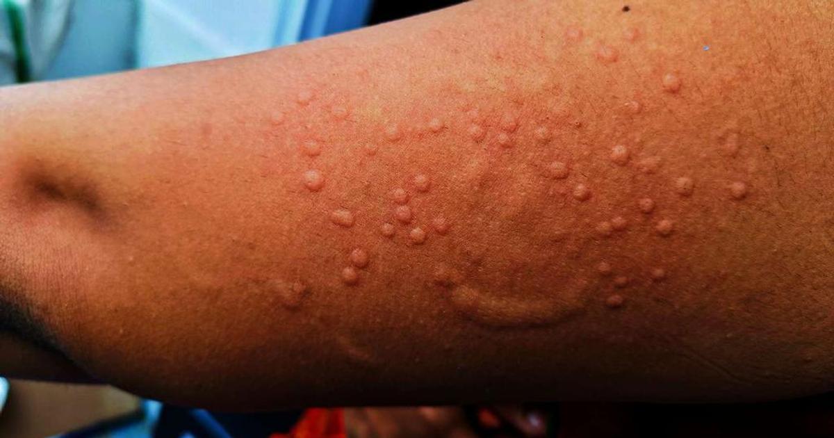 Ugandan patient triggers Monkeypox outbreak alert in Kenya | Pulse Uganda