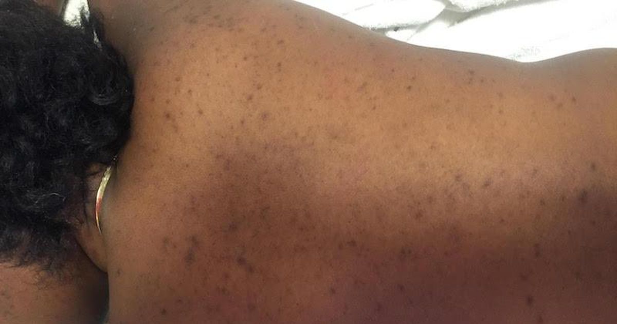 What acne on different parts of your body means | Pulse Uganda