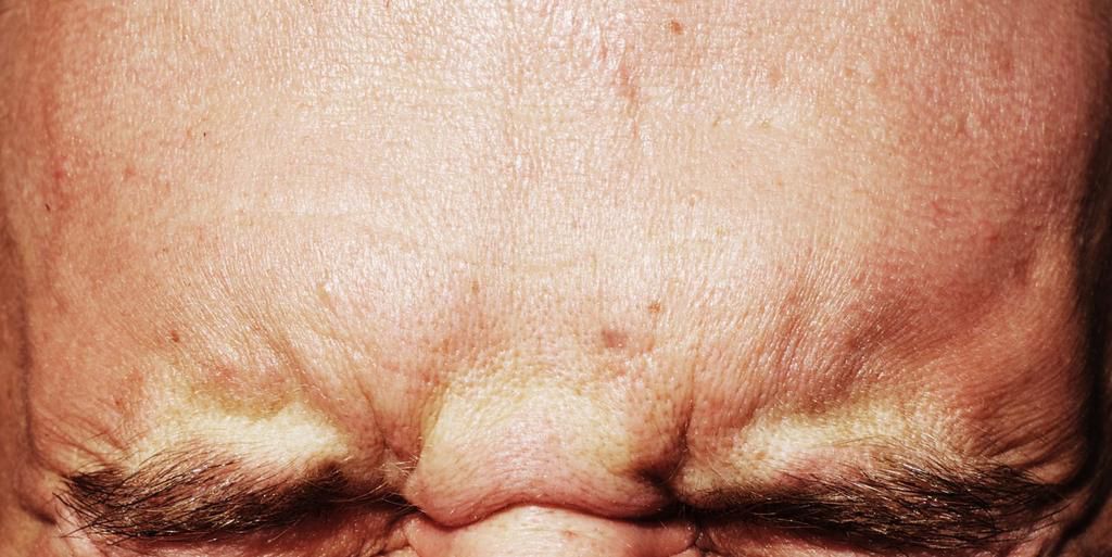 Dr. Pimple Popper Just Cleared This Man's Blackhead-Covered Forehead ...