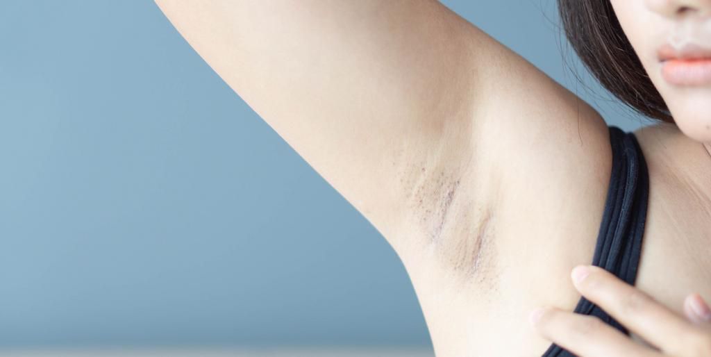 Dr. Pimple Popper Just Squeezed A Forgotten Armpit Steatocystoma In New ...